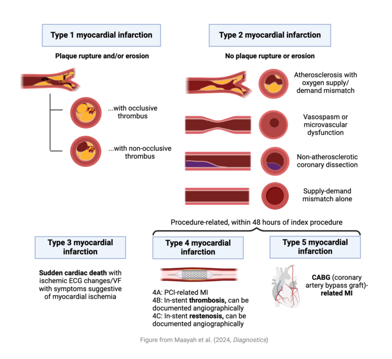 MI Types 1, 2, 3, 4, 5 – Troponin Toolbox